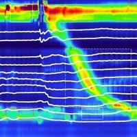 Solar GI HRIM | MKS Medic